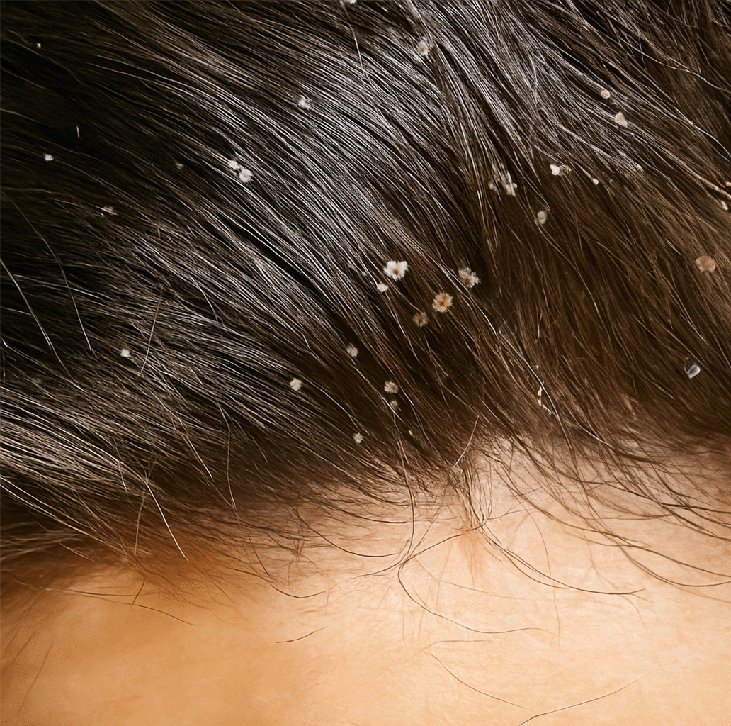 Goodbye dandruff pack – The Cosmetic Republic
